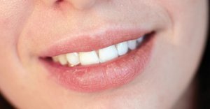 Can Diabetes Cause Dry Lips? 9 Solutions - Beat Diabetes