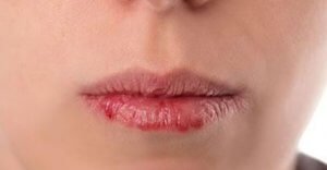 Can Diabetes Cause Dry Lips? 9 Easy Tips for Prevention - Beat Diabetes