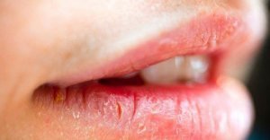 Can Diabetes Cause Dry Lips? 9 Solutions - Beat Diabetes